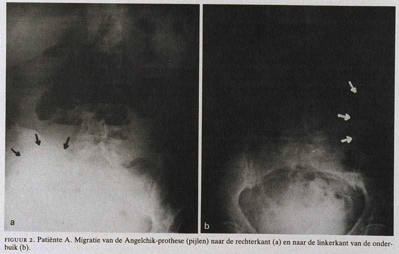 De Angelchik-prothese bij de behandeling van gastro-oesofageale reflux ...