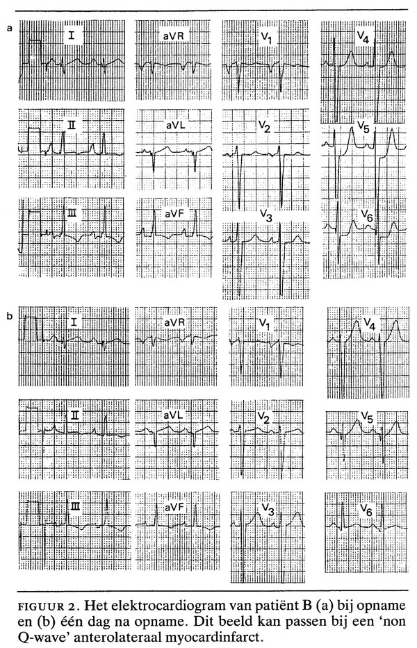 Normale kransslagaders en toch een hartinfarct? | Nederlands ...