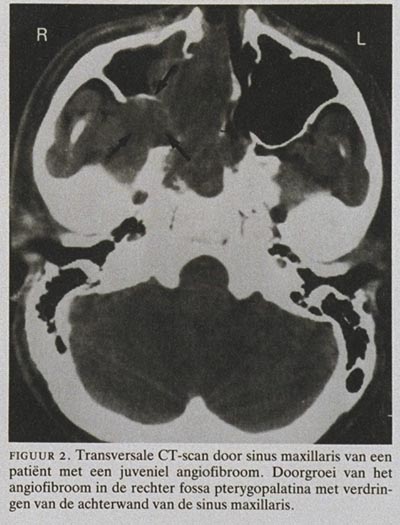 Het juveniele angiofibroom van de neus-keelholte; een overzicht van 20 ...