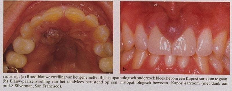 Mondaandoeningen bij HIV-infectie; eerste ervaringen bij veertig ...