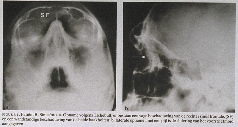 Neusbijholtenproblemen | NTVG