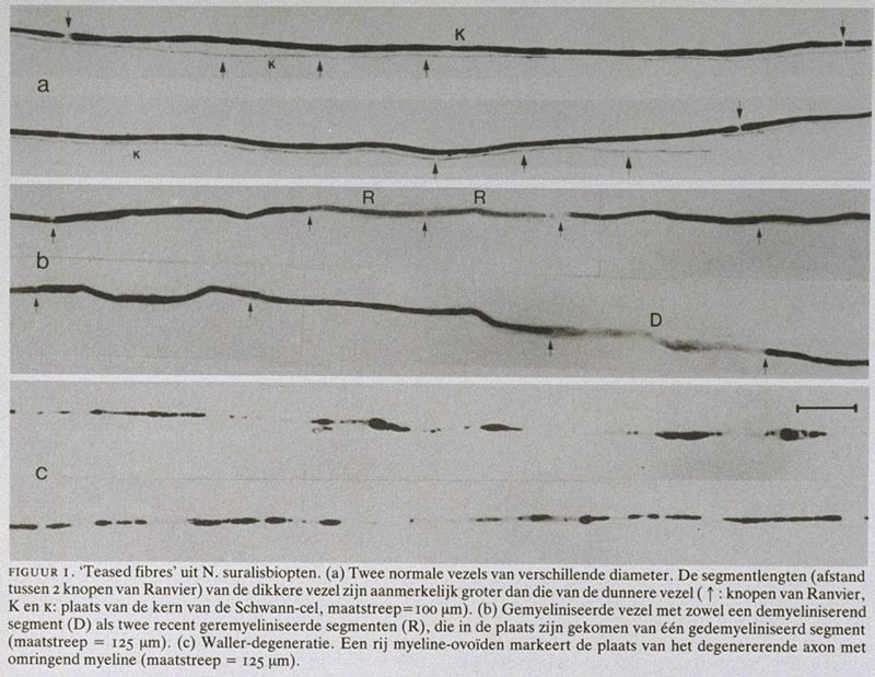 Morfologisch onderzoek van zenuwbiopten | Nederlands Tijdschrift voor ...