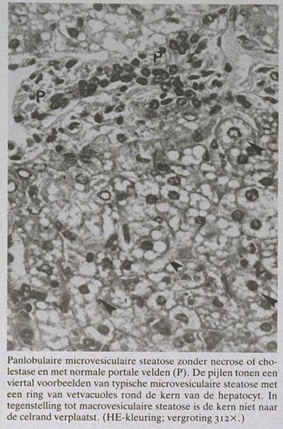 Het syndroom van Reye in Nederland: verslag van een enquête over de ...