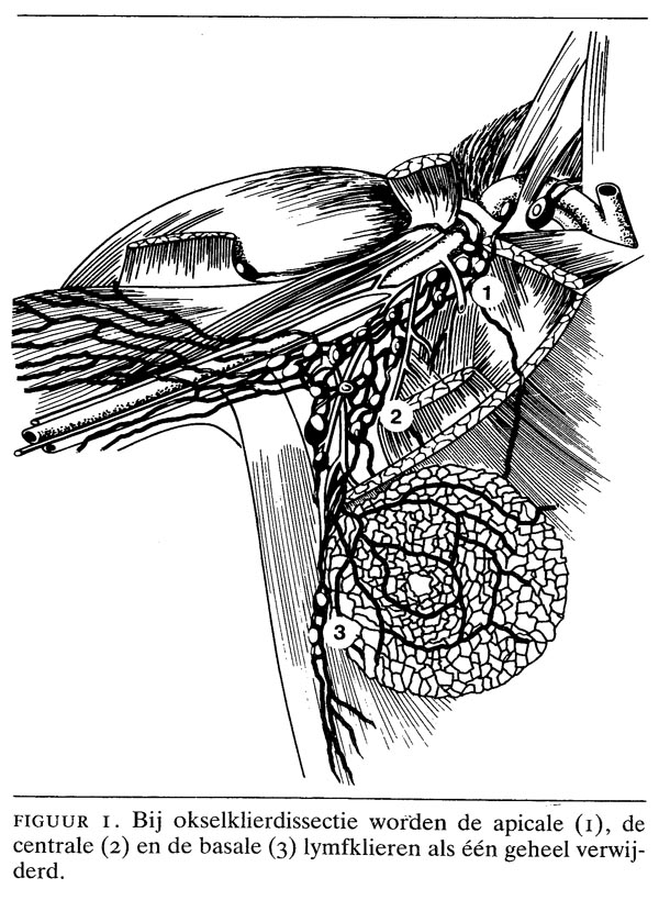 Chirurgische behandeling van recidief van mammacarcinoom in de oksel ...