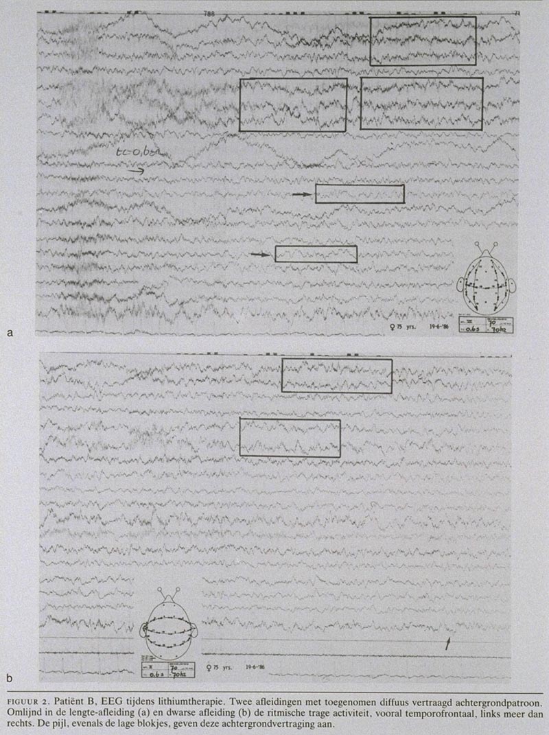 Neurotoxiciteit van lithium bij een normale lithiumspiegel | Nederlands Tijdschrift voor Geneeskunde