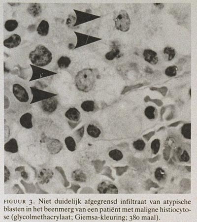 Diagnostiek en behandeling van maligne histiocytose | Nederlands ...