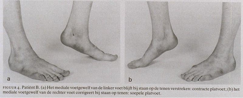 Platvoeten bij kinderen | Nederlands Tijdschrift voor Geneeskunde