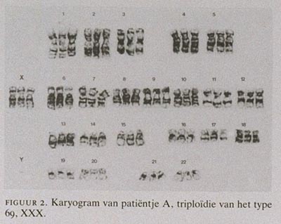Triploïdie bij de pasgeborene; klinisch beloop en cytogenetische ...
