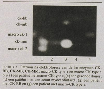 Macro-creatine-kinase: niet iedere verhoogde CK-MB-activiteit duidt op ...
