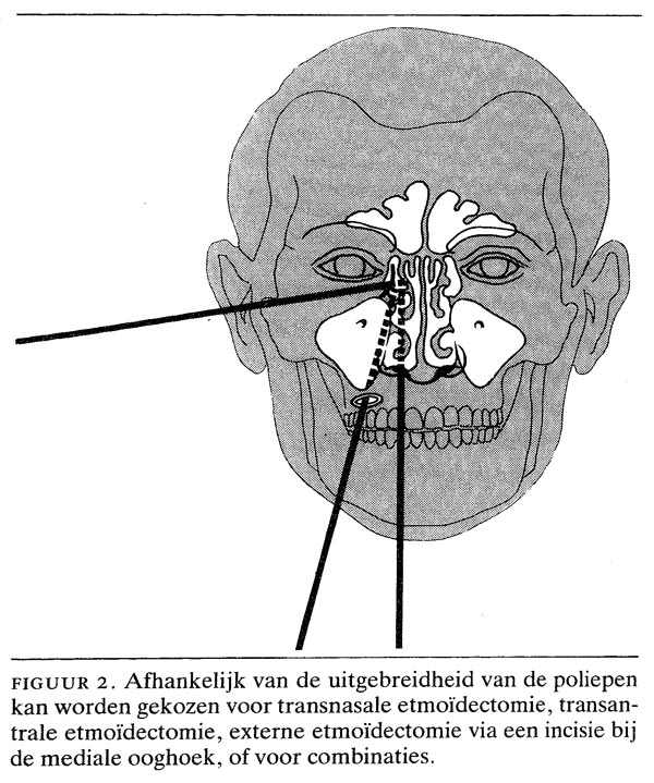 Enkele aspecten van neuspoliepen | Nederlands Tijdschrift voor Geneeskunde