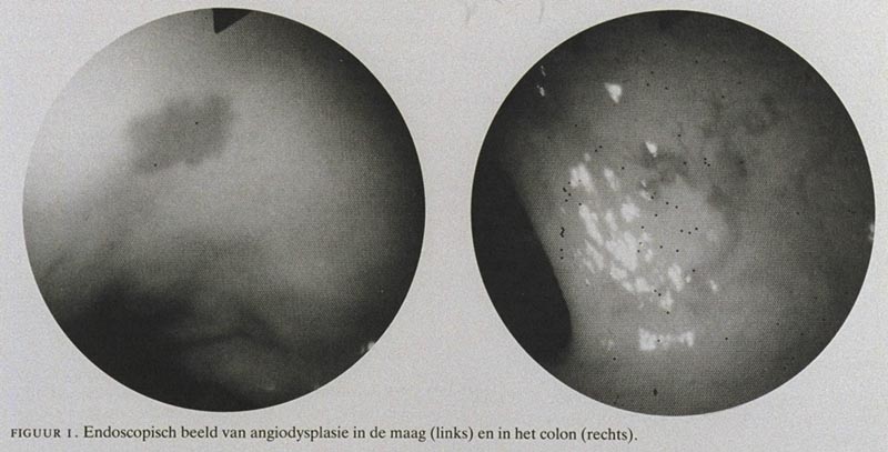 Angiodysplasieën in de tractus digestivus en daarmee verband houdende ...