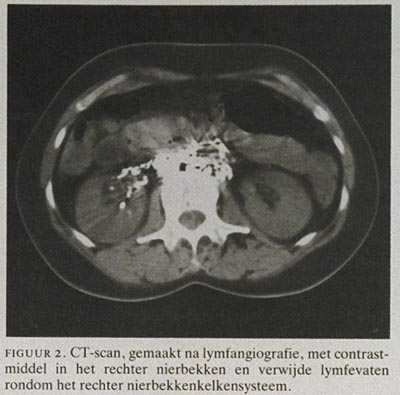 Chylurie door congenitale retroperitoneale lymfangiëctasieën ...