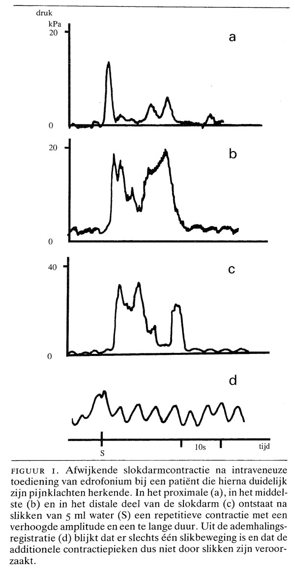 De waarde van ambulante 24-uursslokdarmmanometrie bij de diagnostiek ...