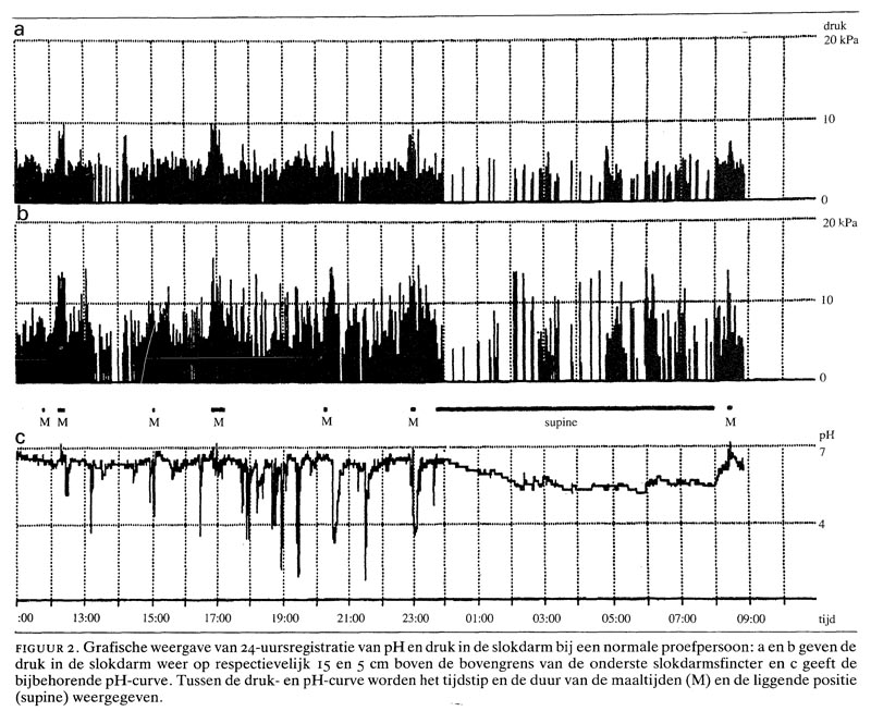 De waarde van ambulante 24-uursslokdarmmanometrie bij de diagnostiek ...