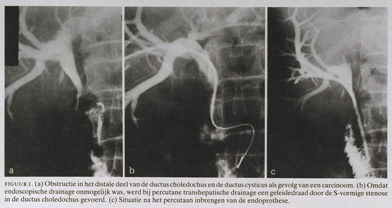Percutane transhepatische galwegdrainage, tien jaar na de introductie ...