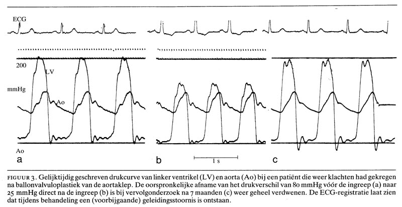 Ballonvalvuloplastiek van de aortaklep: resultaten op korte en ...