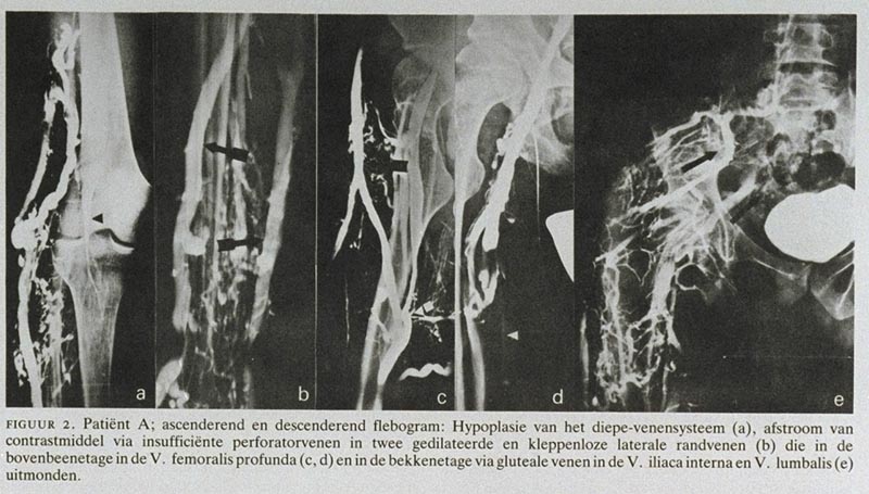 Congenitale angiodysplasie van de ledematen; diagnose en therapie ...