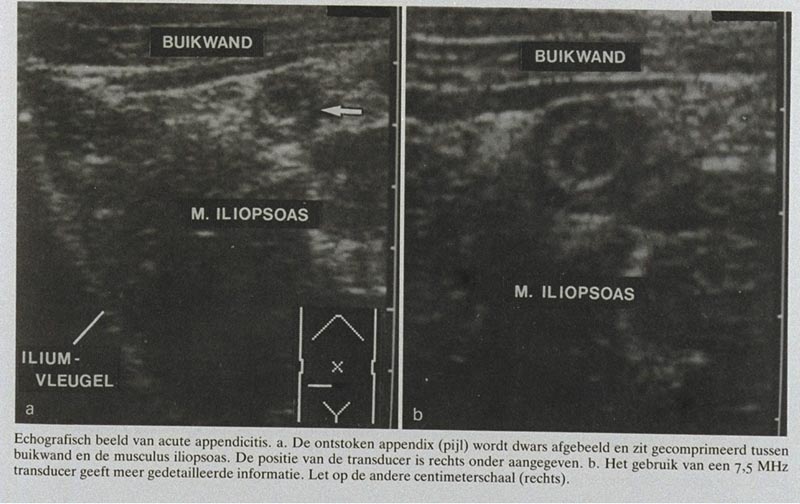 Echografie bij appendicitis | NTVG