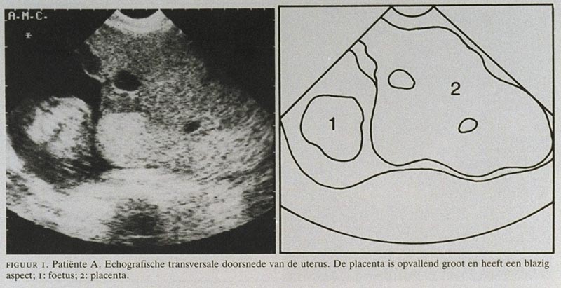 Prenatale diagnostiek van triploïdie | NTvG
