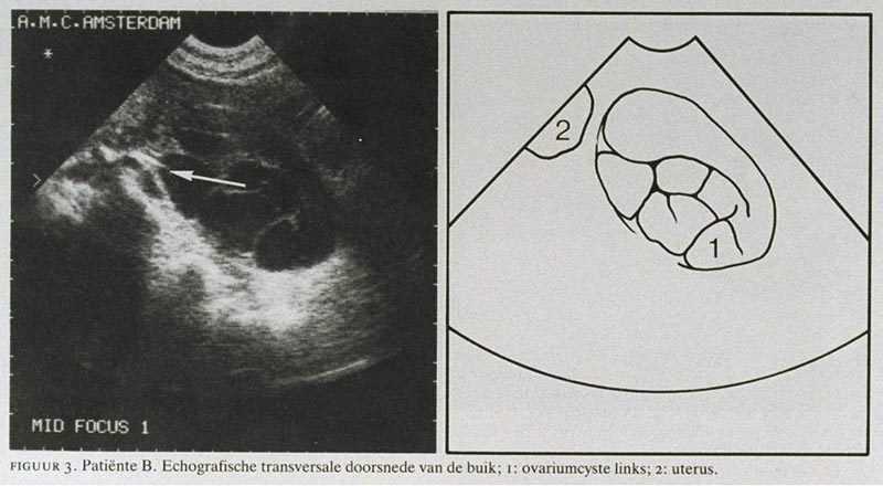 Prenatale diagnostiek van triploïdie | NTvG