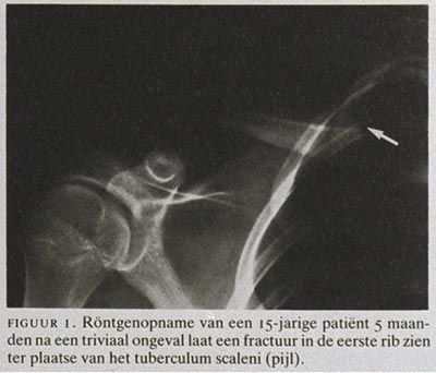 Fractuur van de eerste rib als gevolg van een triviaal ongeval ...