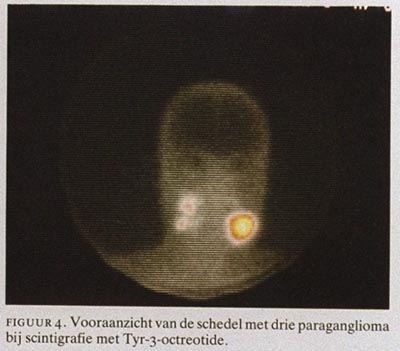 Receptorscintigrafie met somatostatine-analogon in de oncologie ...