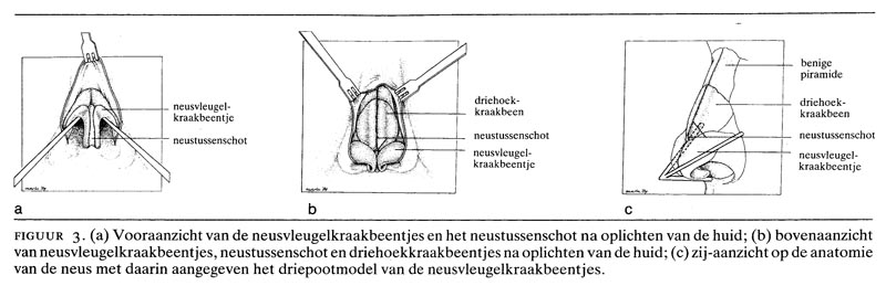De open septorinoplastiek; ervaringen bij 80 patiënten | NTVG