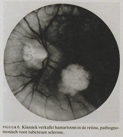 Tubereuze sclerose | NTVG