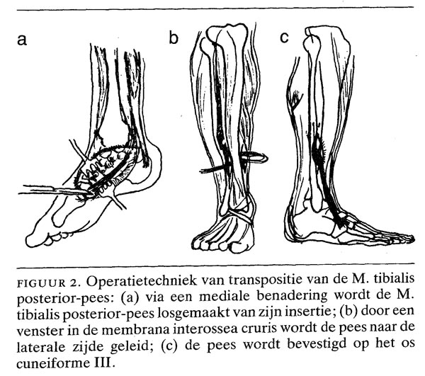 Transpositie van de musculus tibialis posterior-pees bij de ...