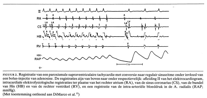 De waarde van adenosine bij de behandeling van supraventriculaire ...