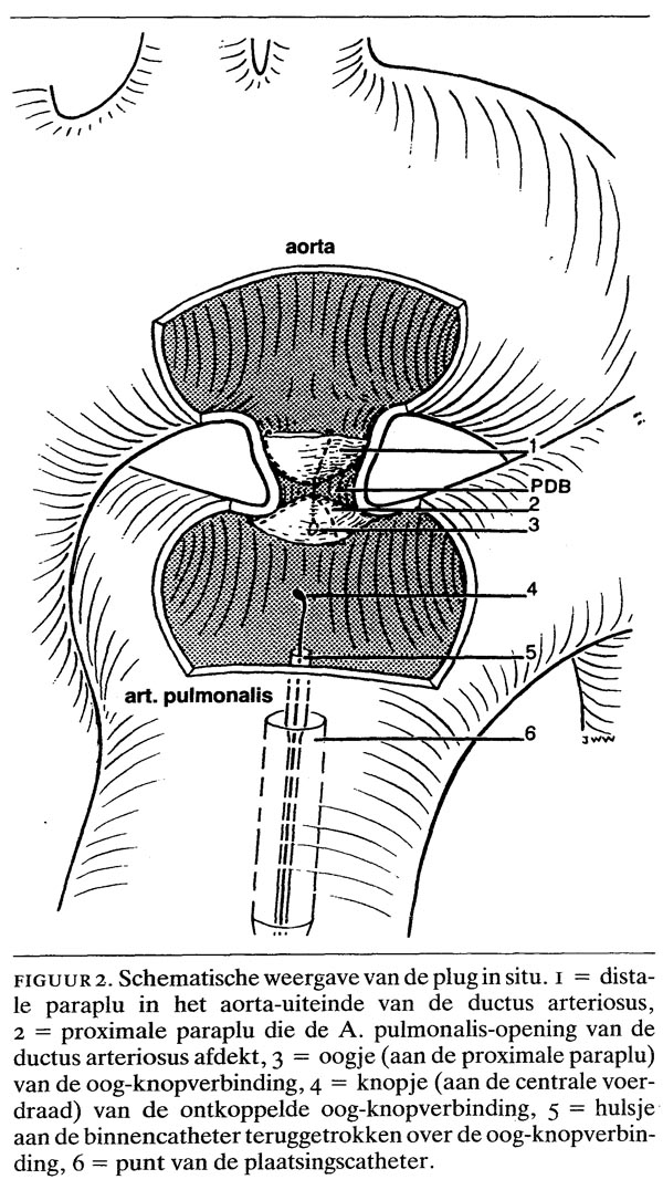 Sluiting van de persisterende ductus arteriosus (Botalli) door middel ...