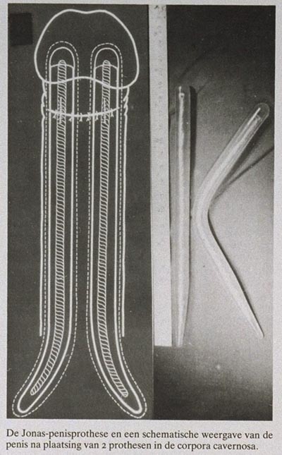 Ervaringen van patiënten met de semi-rigide Jonas-penisprothese ...