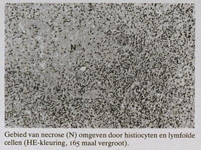 Histiocytaire necrotiserende lymfadenitis; de ziekte van Kikuchi | NTVG