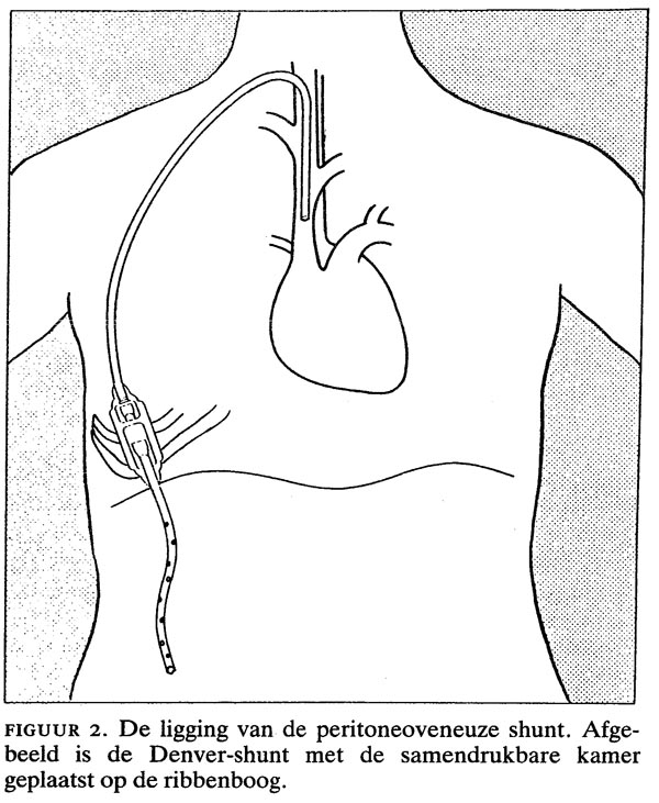 De peritoneoveneuze shunt in de behandeling van ascites door een ...