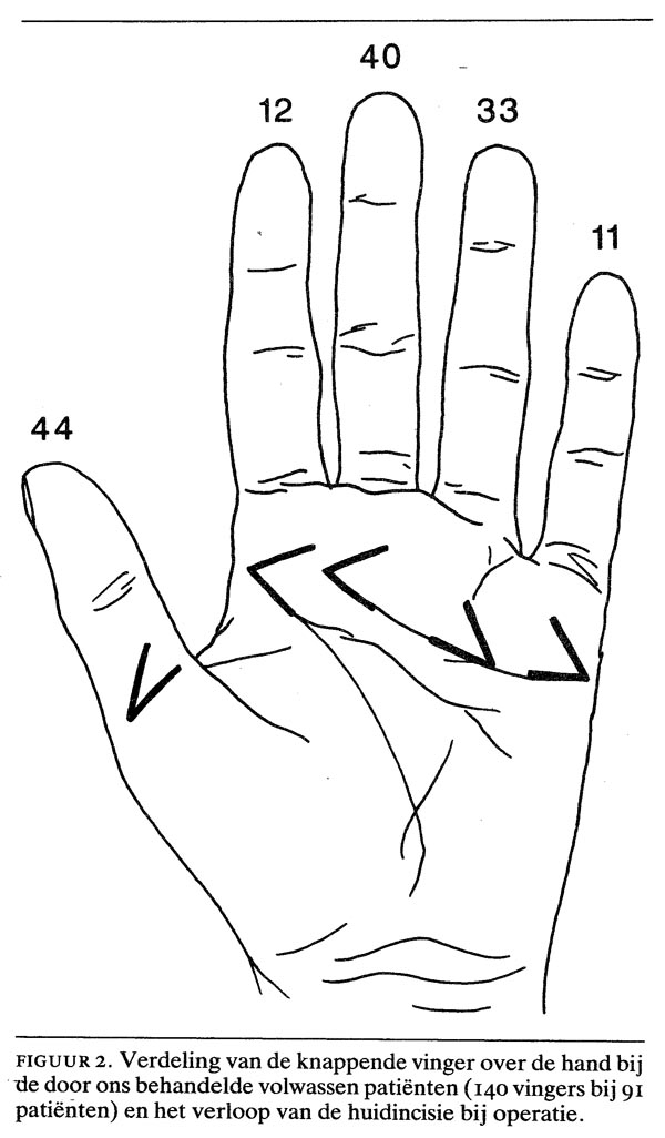 Goede resultaten met chirurgische behandeling van de knappende vinger ...