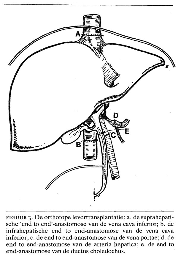 Levertransplantatie bij acute leverinsufficiëntie: definitieve ...