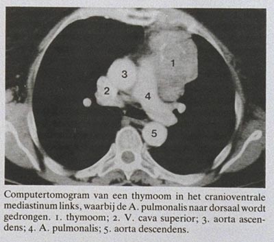 Thy(mo)mectomie als behandeling van myasthenia gravis en van het ...