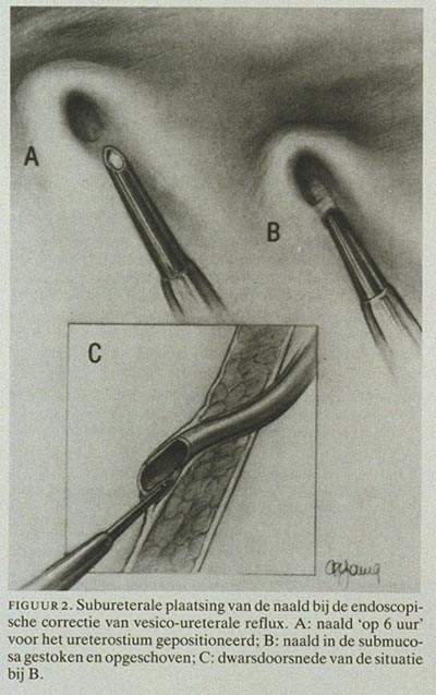 De 'STING'-procedure: subureterale teflon-applicatie bij vesico ...