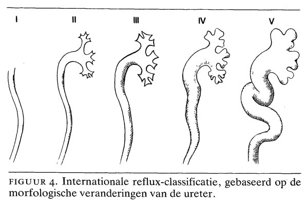 De 'STING'-procedure: subureterale teflon-applicatie bij vesico ...