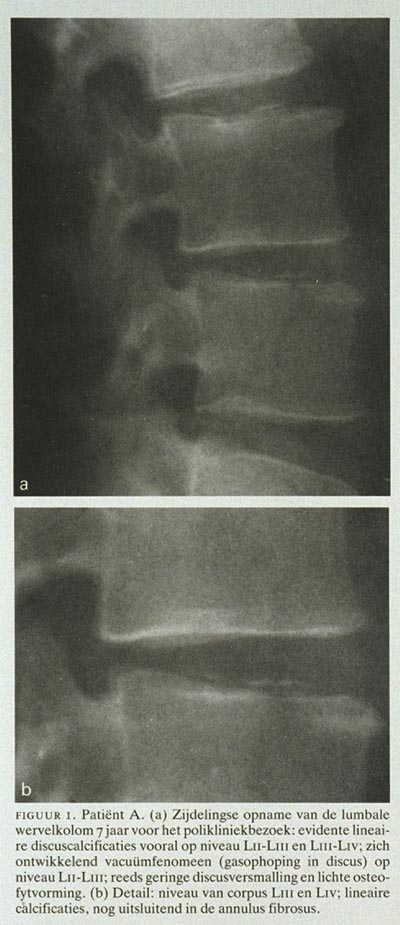 Een zeldzame oorzaak van chronische rugklachten: ochronose | NTVG