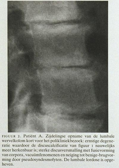 Een zeldzame oorzaak van chronische rugklachten: ochronose | NTVG