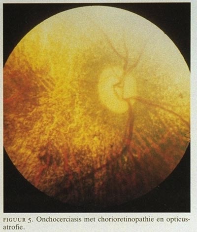 Blindheidbestrijding in ontwikkelingslanden | Nederlands Tijdschrift ...