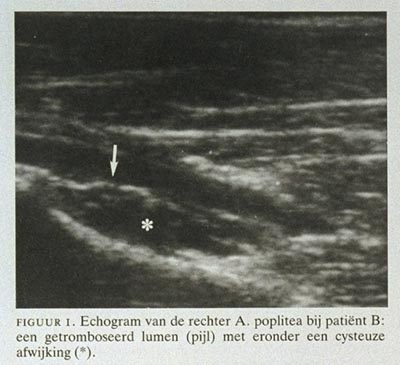 Claudicatio intermittens bij jeugdige patiënten | Nederlands ...