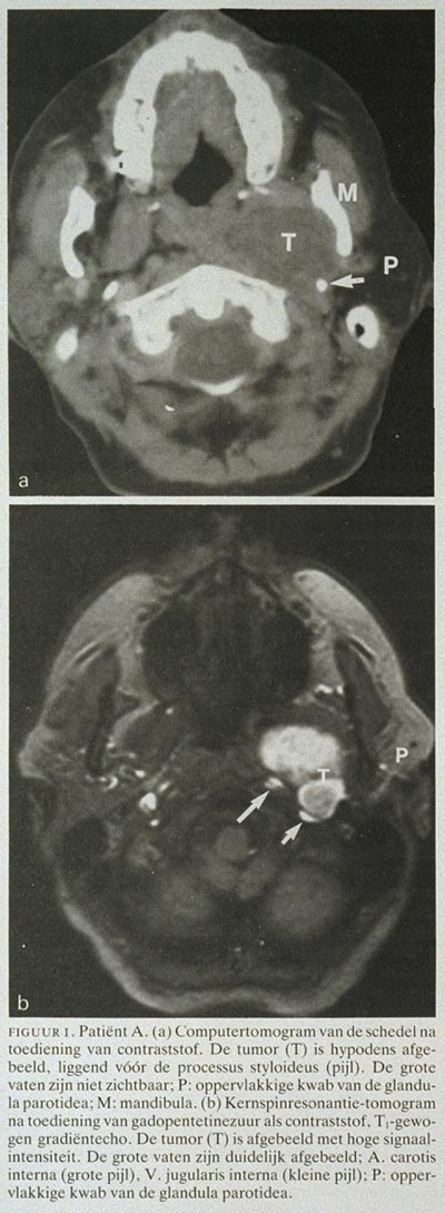 Otitis media met effusie als eerste symptoom van een parafaryngeale ...