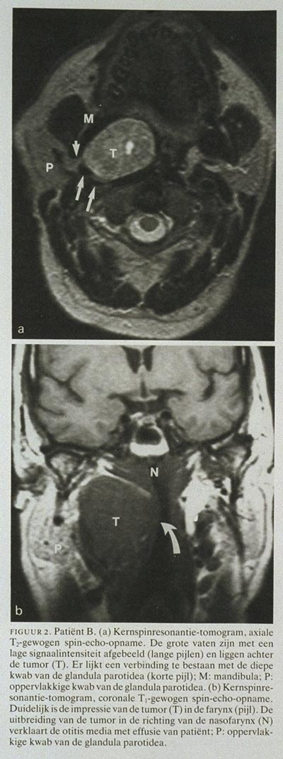 Otitis media met effusie als eerste symptoom van een parafaryngeale ...