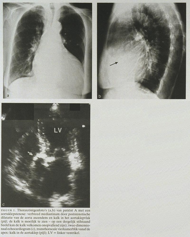 Aortaklepstenose als oorzaak van decompensatio cordis | NTVG