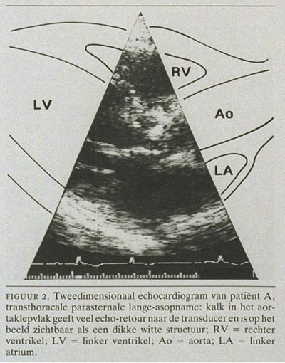 Aortaklepstenose als oorzaak van decompensatio cordis | NTVG
