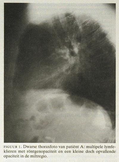 Een verrassende dubbeltumor van de lever 60 jaar na thorotrast ...