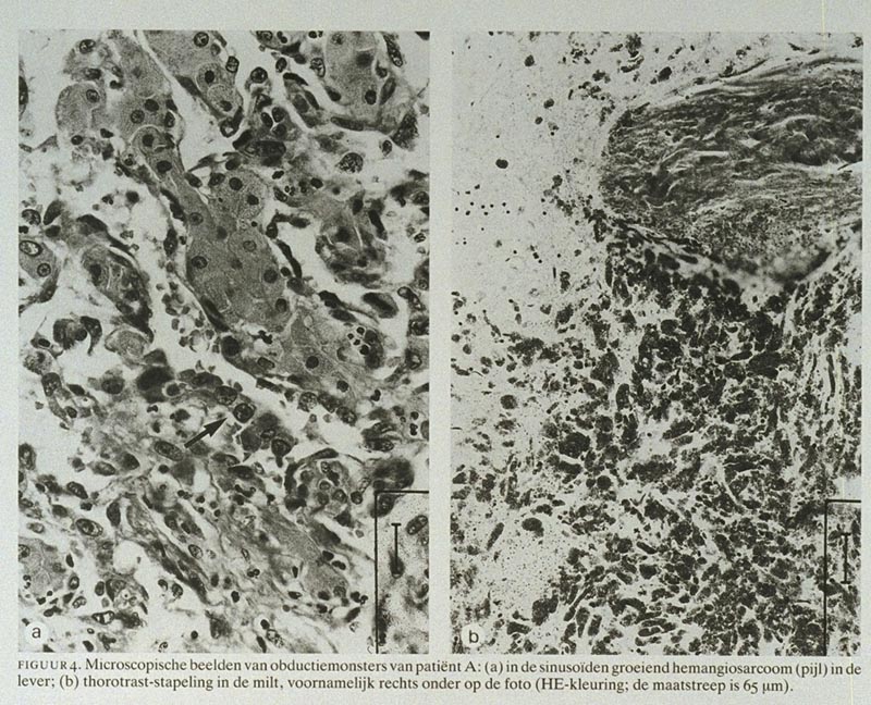 Een verrassende dubbeltumor van de lever 60 jaar na thorotrast ...