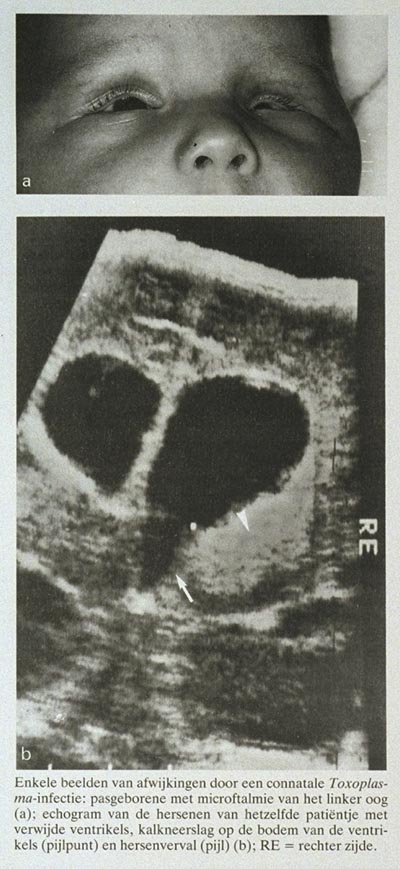 Preventie van congenitale toxoplasmose | NTvG